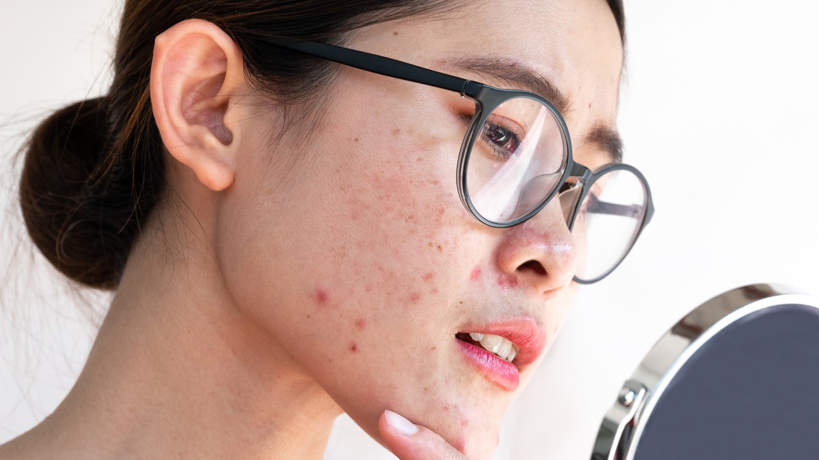 All You Need To Know About Blind Pimples
