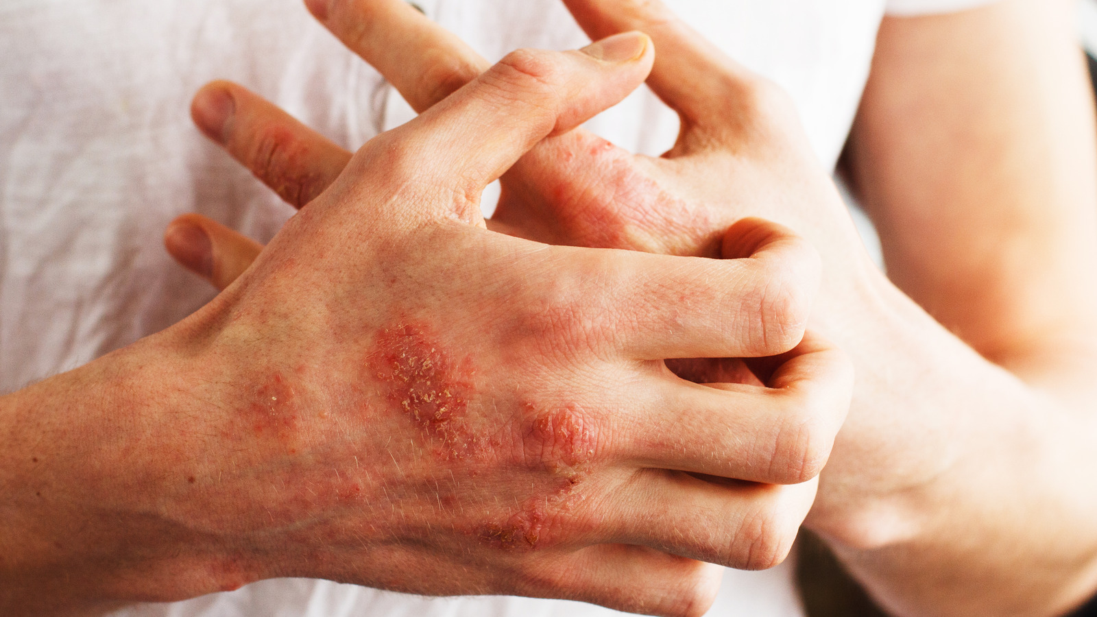 Can CBD Help Ease Symptoms Of Plaque Psoriasis?