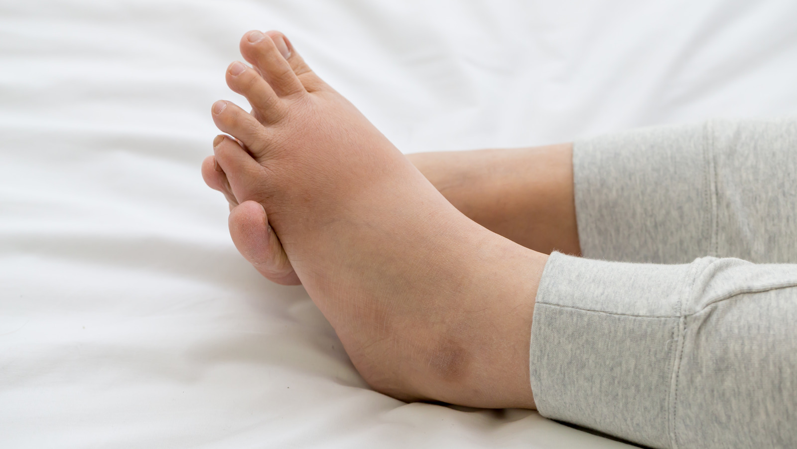 Everything You Need To Know About Oedema
