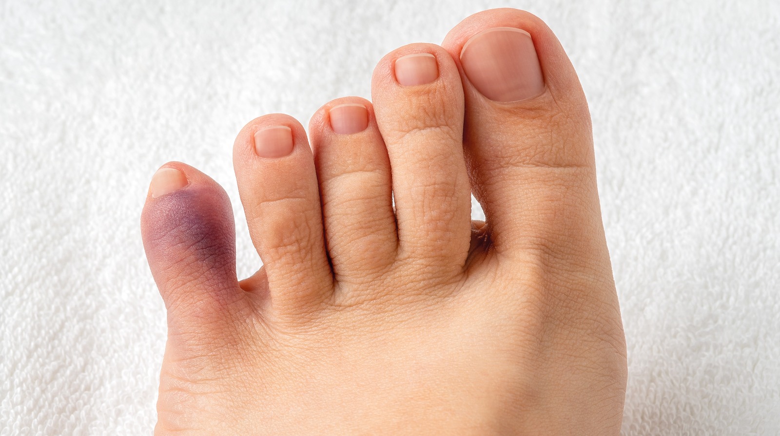How Long Does It Take For A Broken Toe To Heal How Long Does It Take For A Broken Toe To Heal