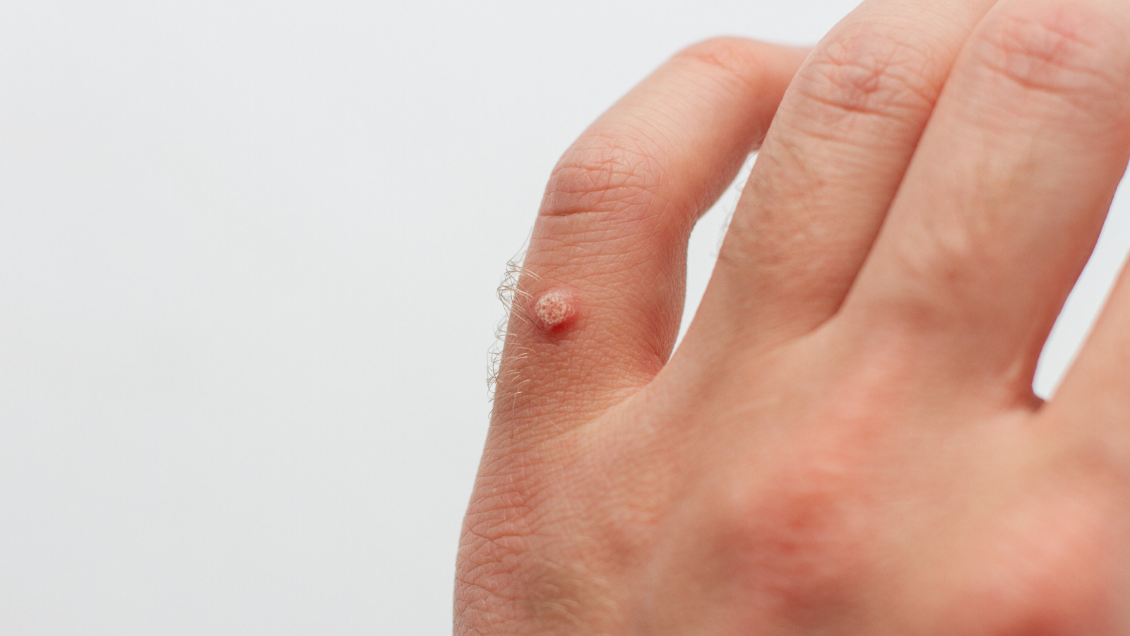 How To Safely Remove A Wart