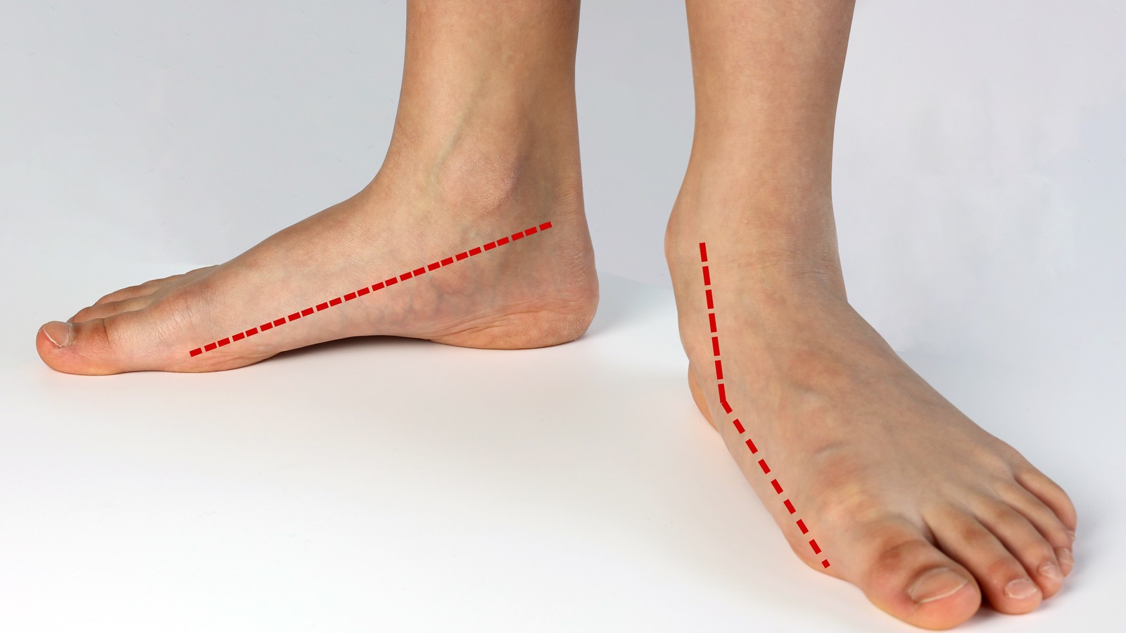How To Tell If You Have Flat Feet How To Tell If You Have Flat Feet