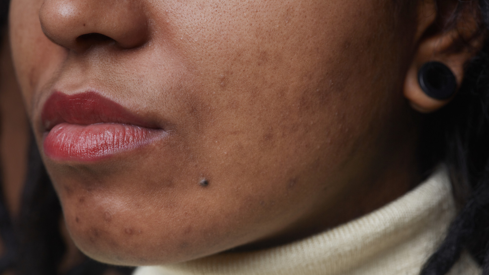 How To Tell The Difference Between A Pimple And A Cold Sore