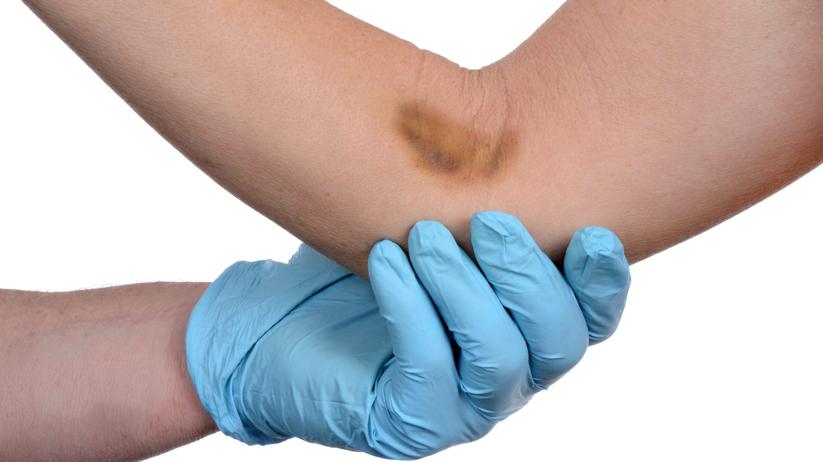 Is It Normal To Bruise After Getting Blood Drawn Is It Normal To Bruise After Getting Blood Drawn