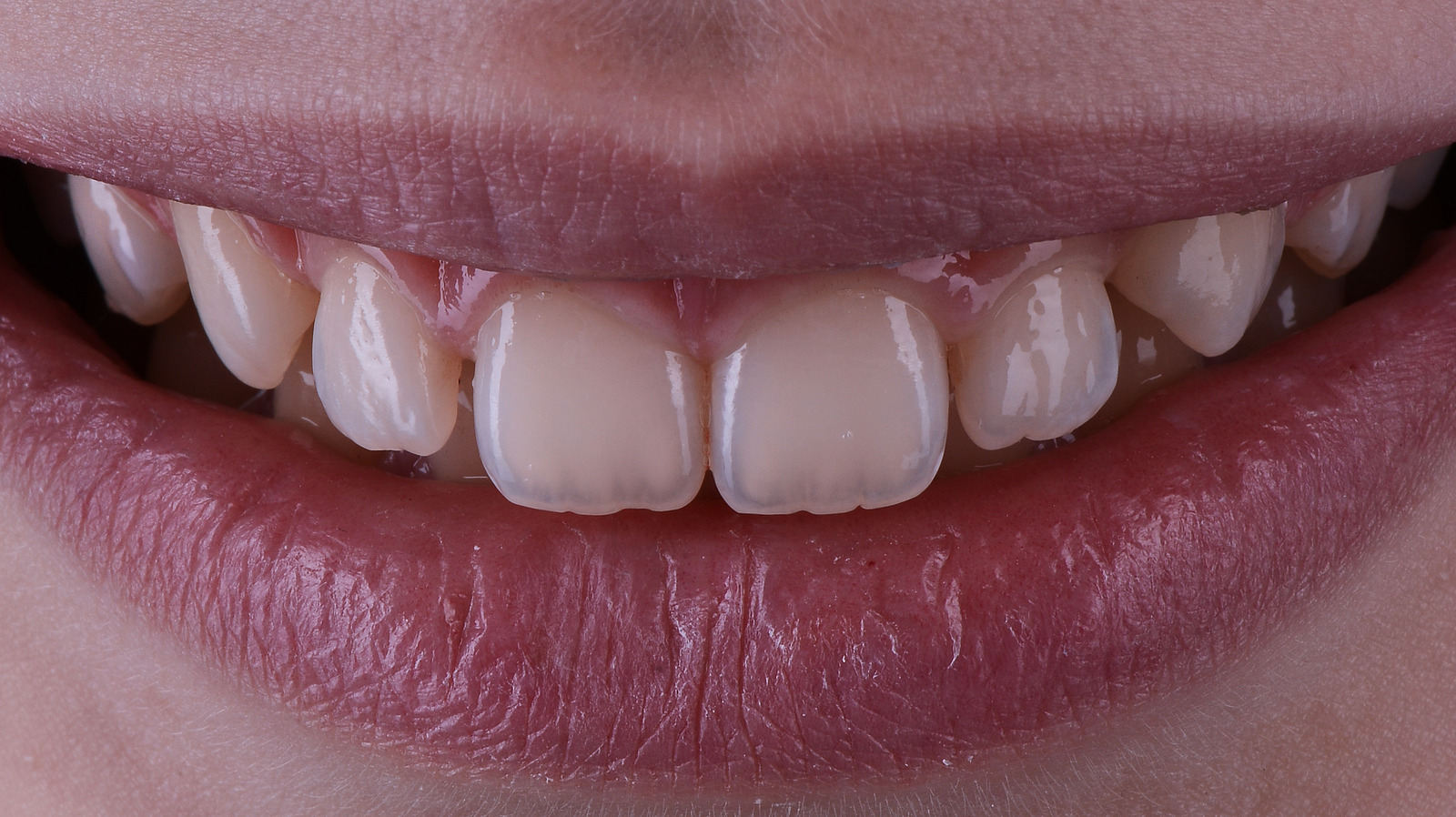 The Real Reason You Have Ridges On Your Teeth The Real Reason You Have Ridges On Your Teeth