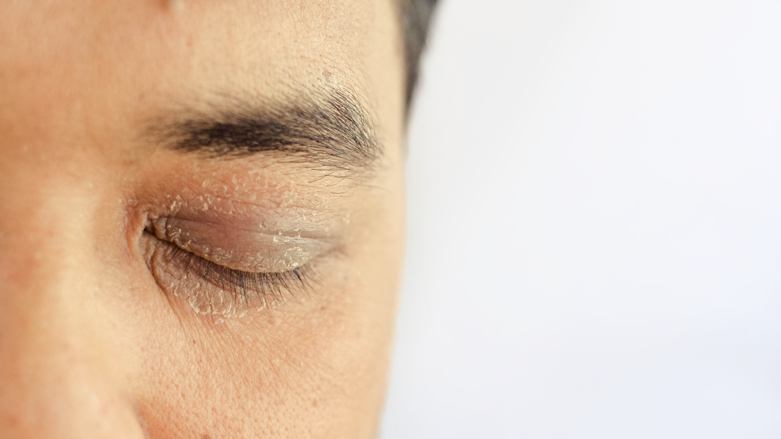 What Causes Flaky Eyelids?