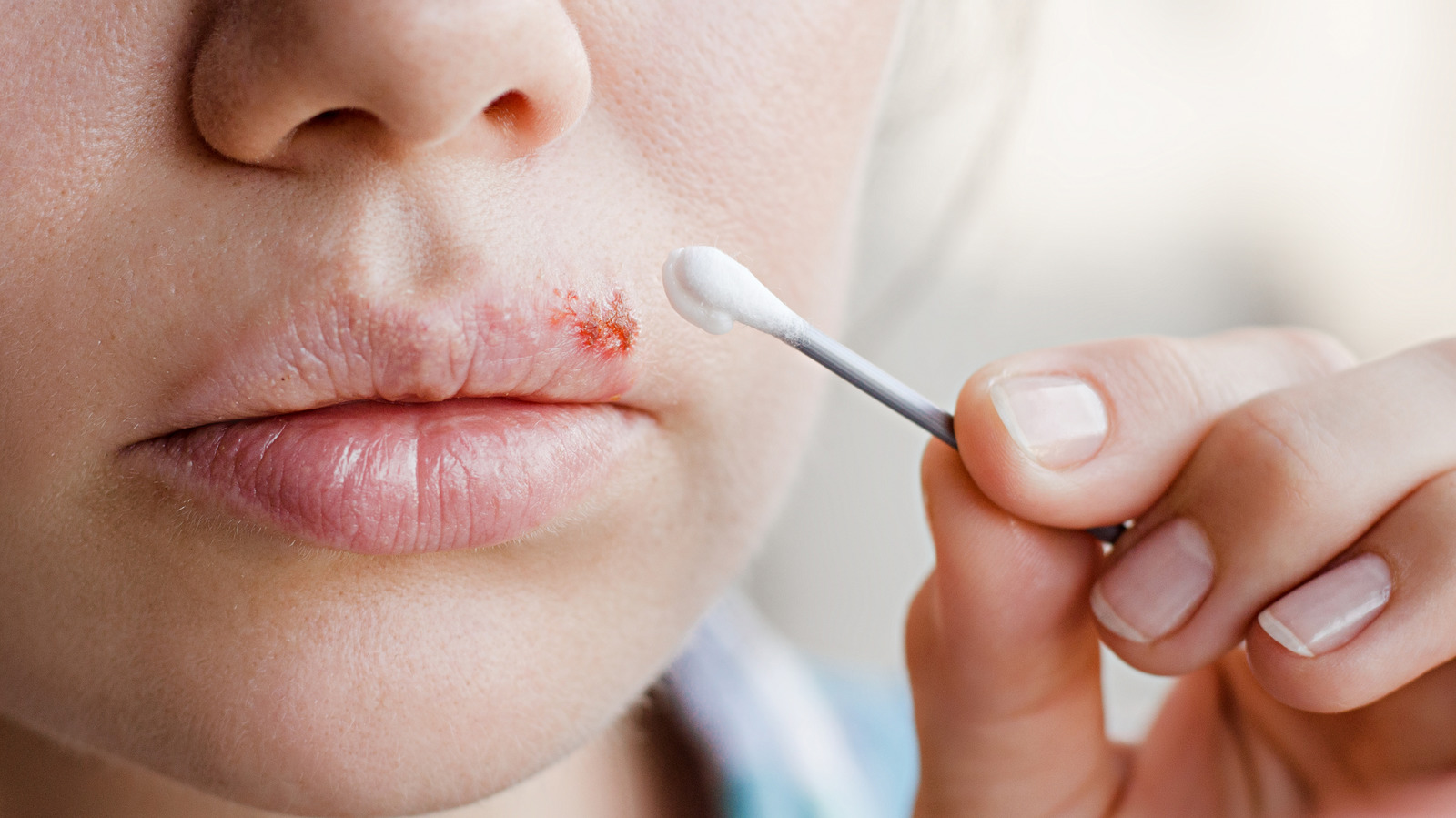 What Really Causes Cold Sores?