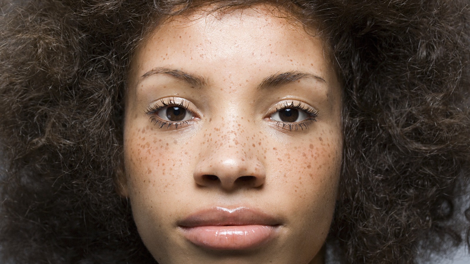 When You Should See A Skin Doctor About Your Freckles